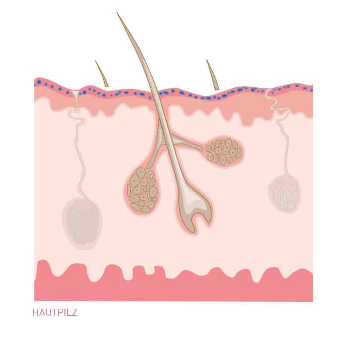Hautpilz - Hautkrankheiten Portal